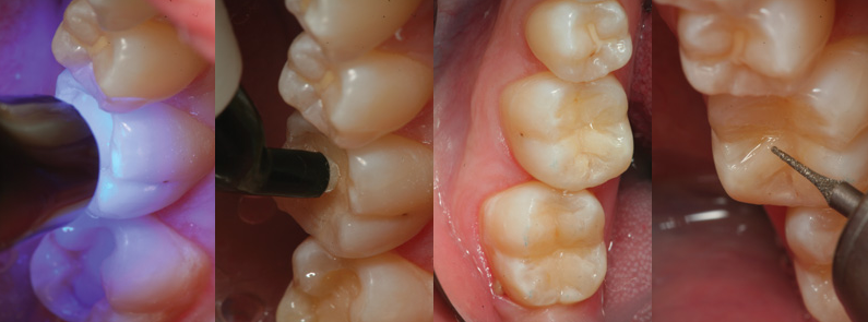 Dental Fillings | Best Dental Clinics in Dubai